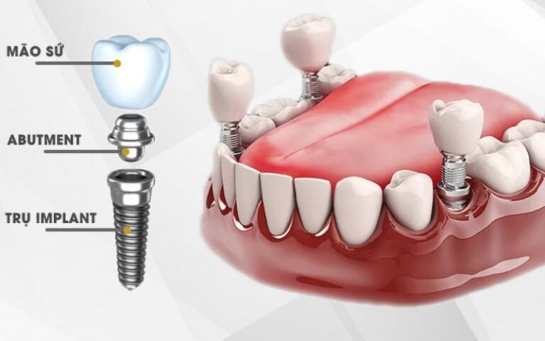 Healing Implant là gì? Các loại Healing Implant phổ biến hiện nay