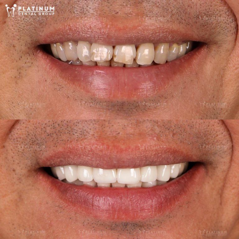 How many types of dental crowns are there? An overview of dental crown ...
