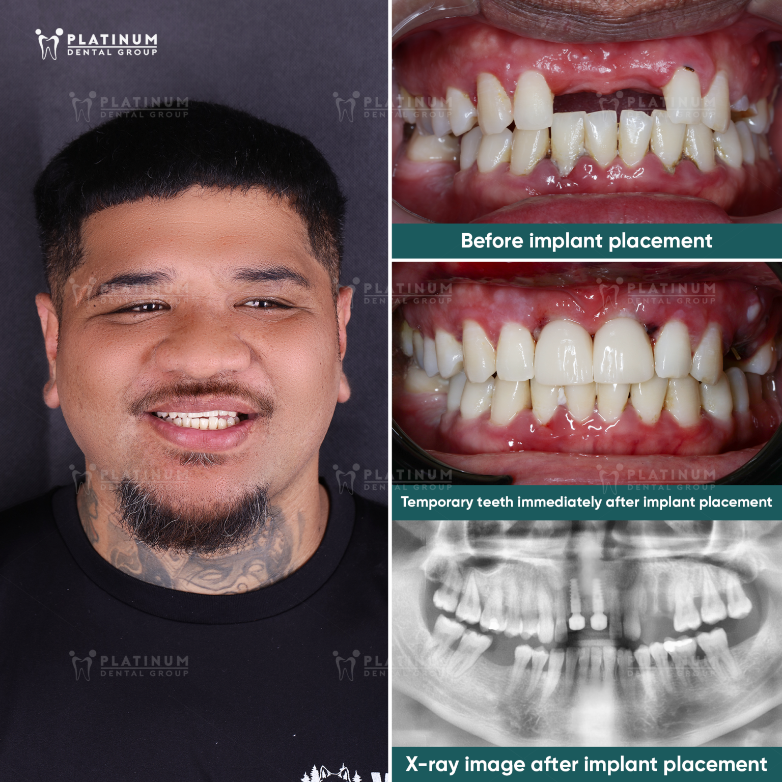 Single Tooth Implant Services - Platinum Dental