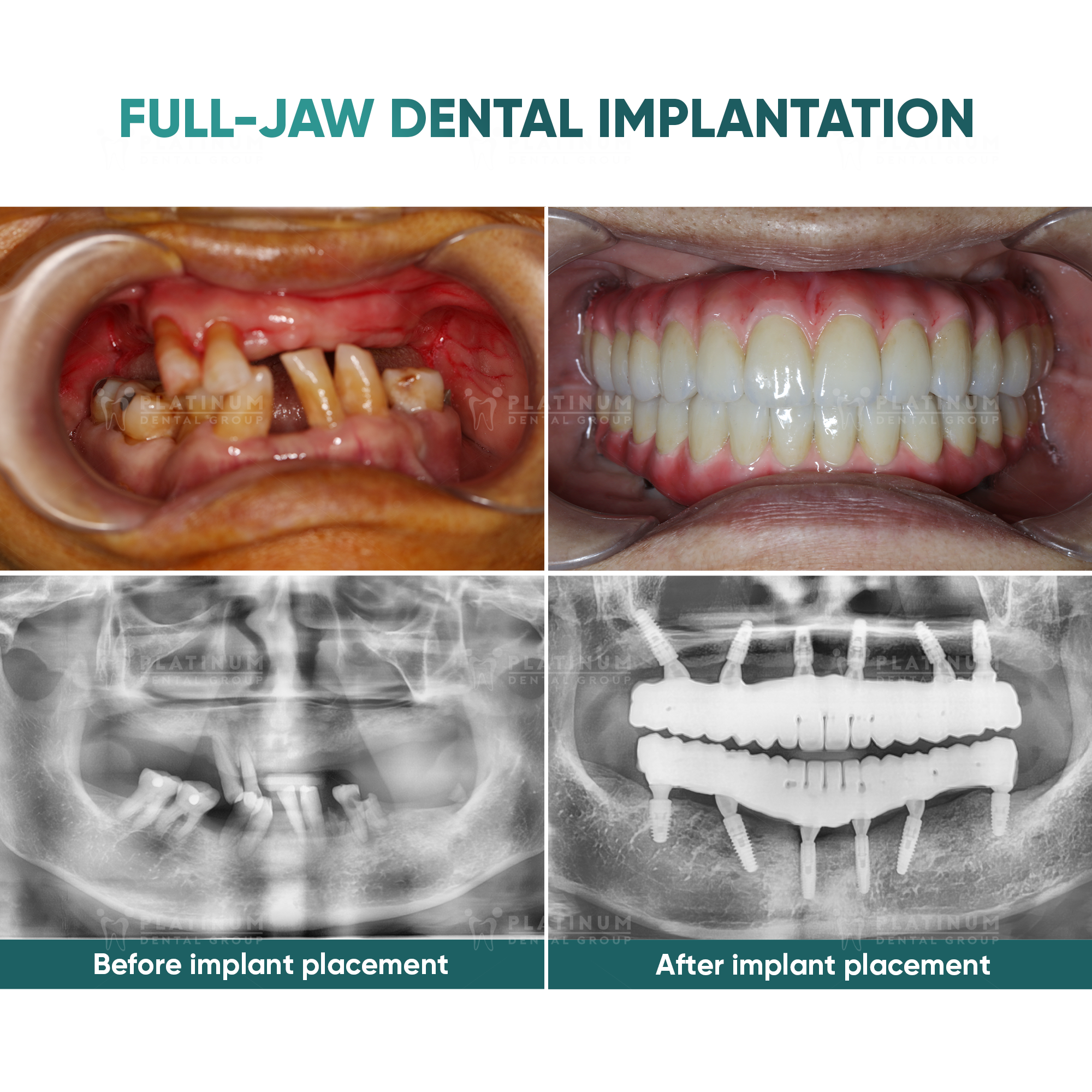 What is Full Mouth Implant? Procedure and Cost of Full Mouth Implant