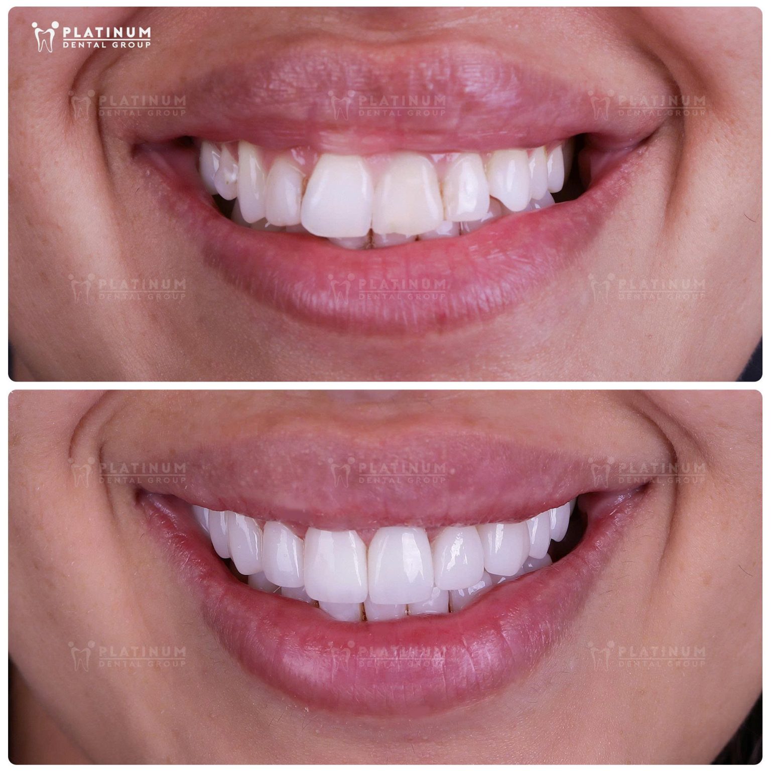 Ceramic vs Porcelain Veneers: Expert Guide | Platinum Dental