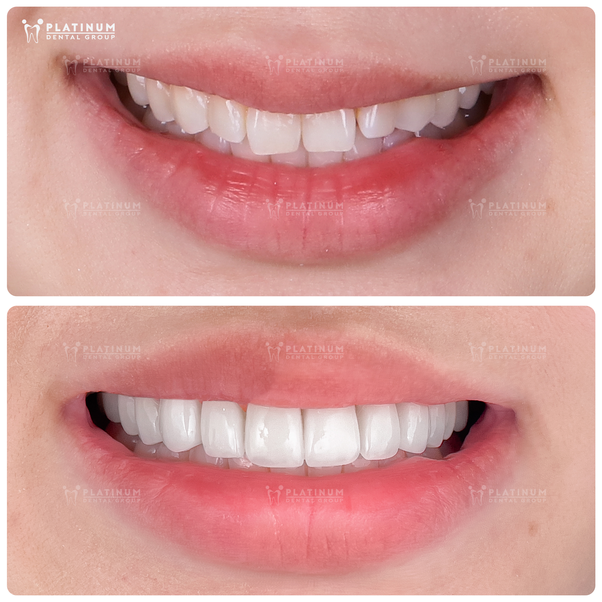 Ceramic vs Porcelain Veneers: Expert Guide | Platinum Dental