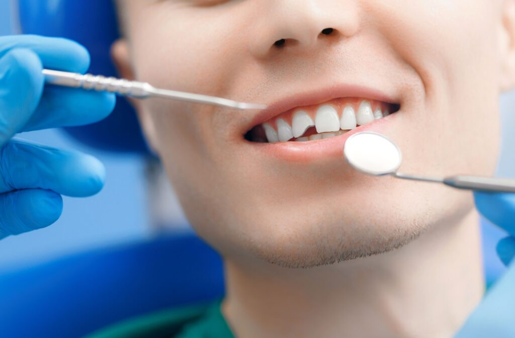 Chipped Tooth: Causes, Treatment & Smile Restoration at Platinum Dental ...