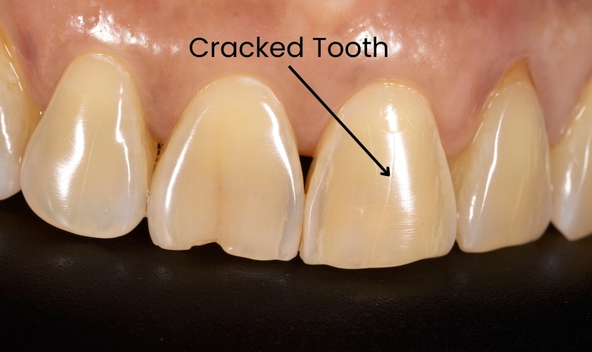 Cracked tooth – causes, symptoms, and treatment options for patients