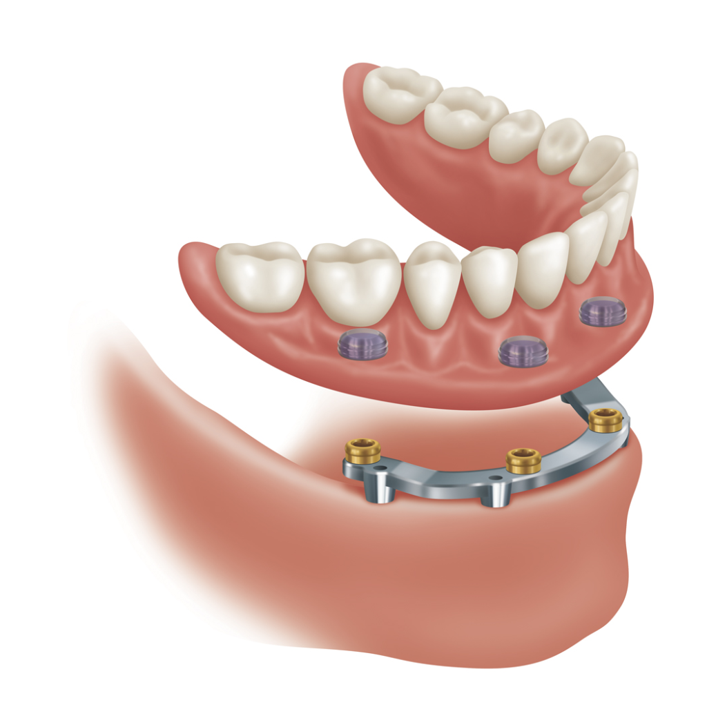 Hàm Tháo Lắp Trên Implant: Giải Pháp Nào Tốt Nhất Cho Người Mất Răng?