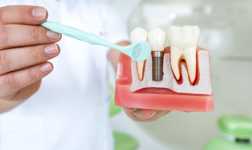 How to Clean Implant Teeth at Home: A Comprehensive Step-by-Step Guide