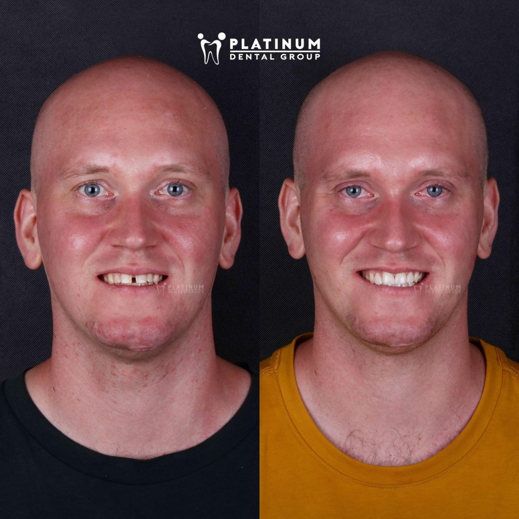 Veneers for Spaced Teeth: Understanding Methods and Techniques ...