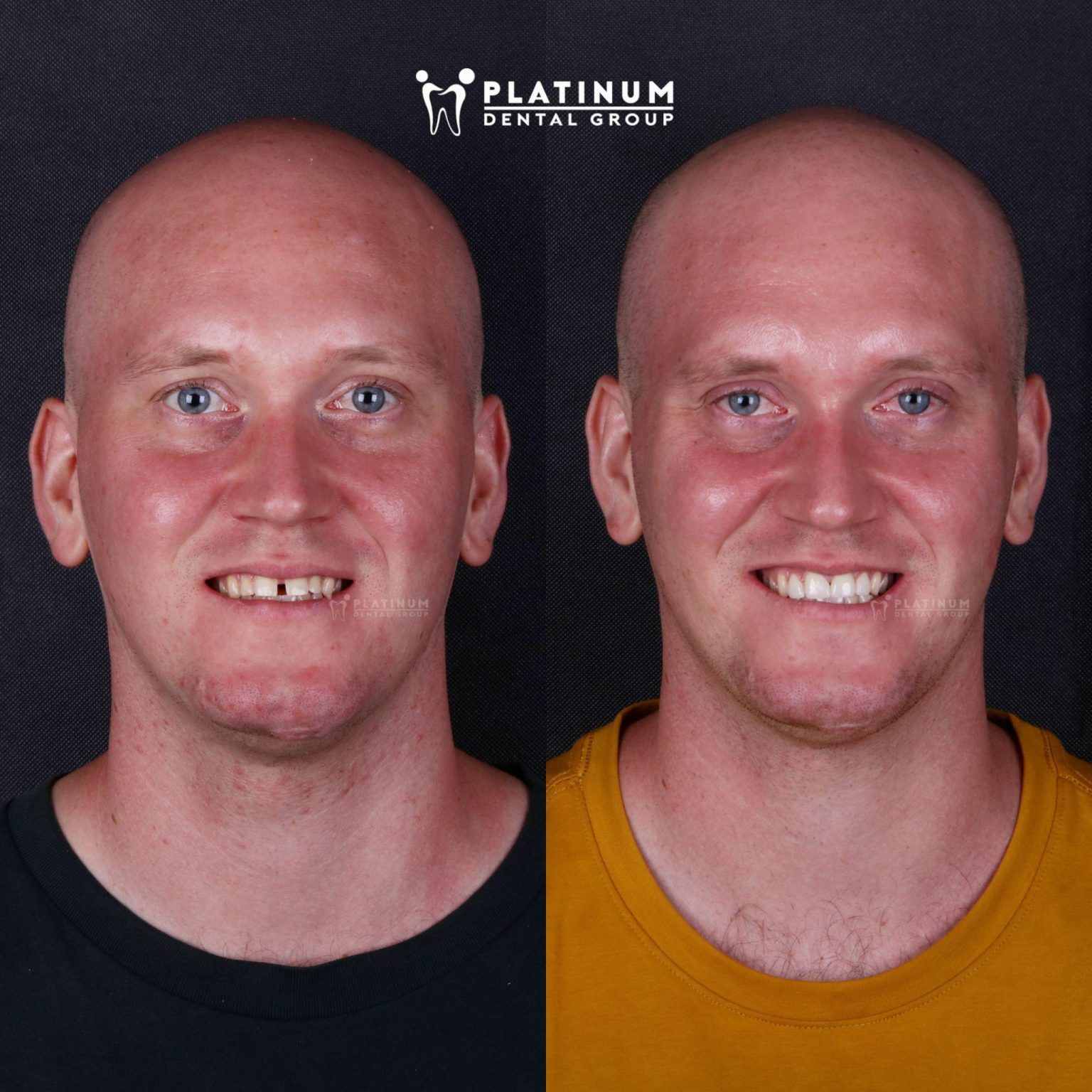 Veneers for Spaced Teeth: Understanding Methods and Techniques ...