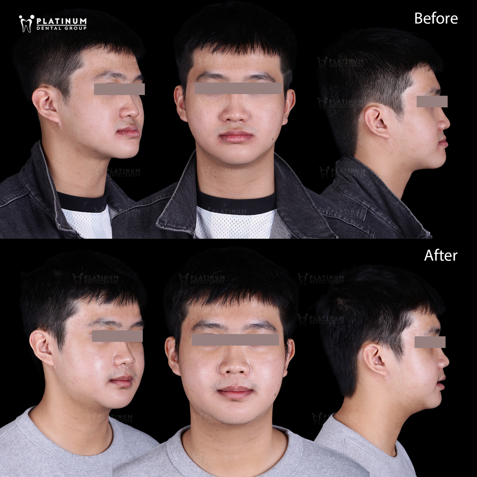 The Truth Behind “Jaw Surgery Ruined My Face”: Expert Insights & Real Cases