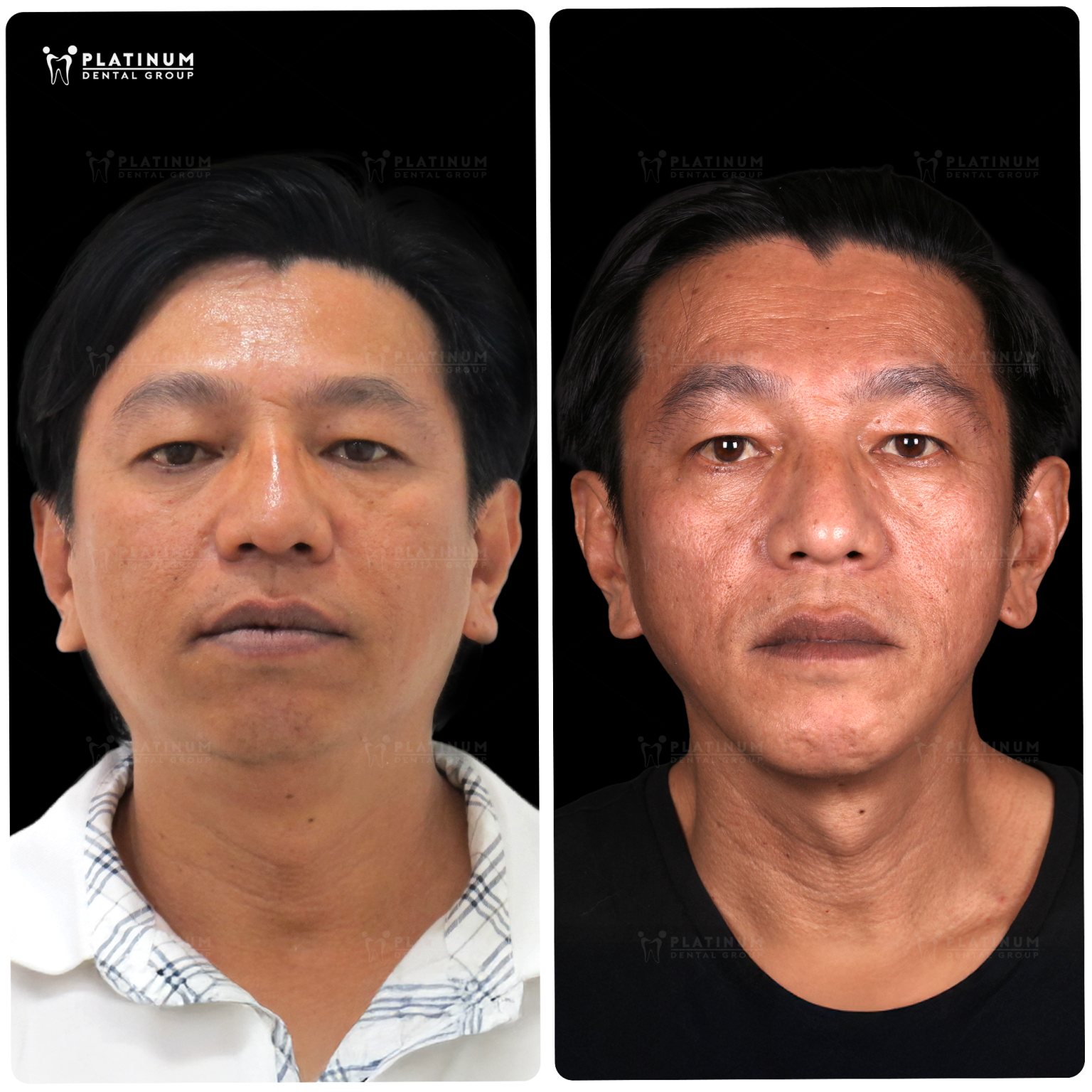 Lower jaw surgery - overview, benefits, procedure & recovery