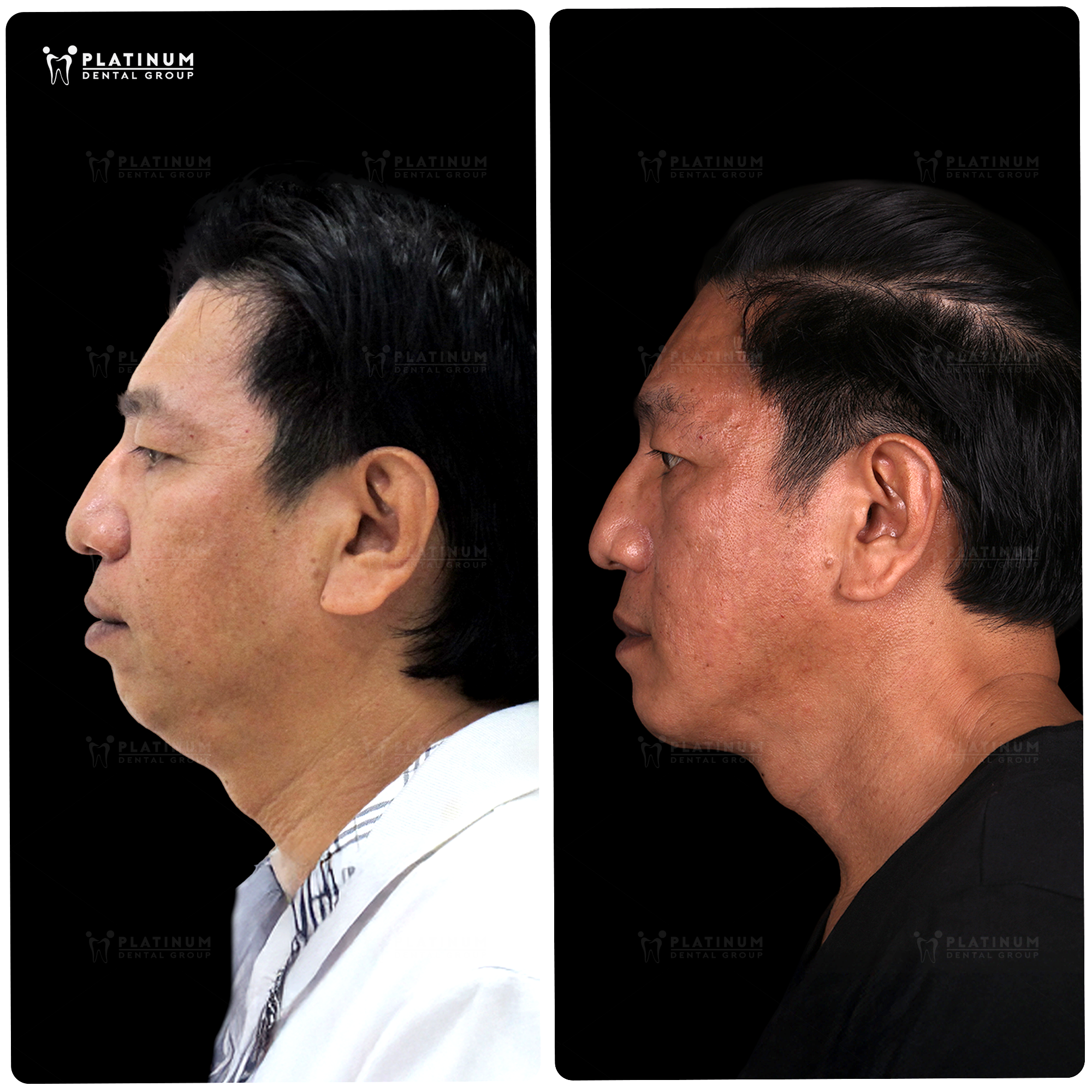 Lower jaw surgery - overview, benefits, procedure & recovery