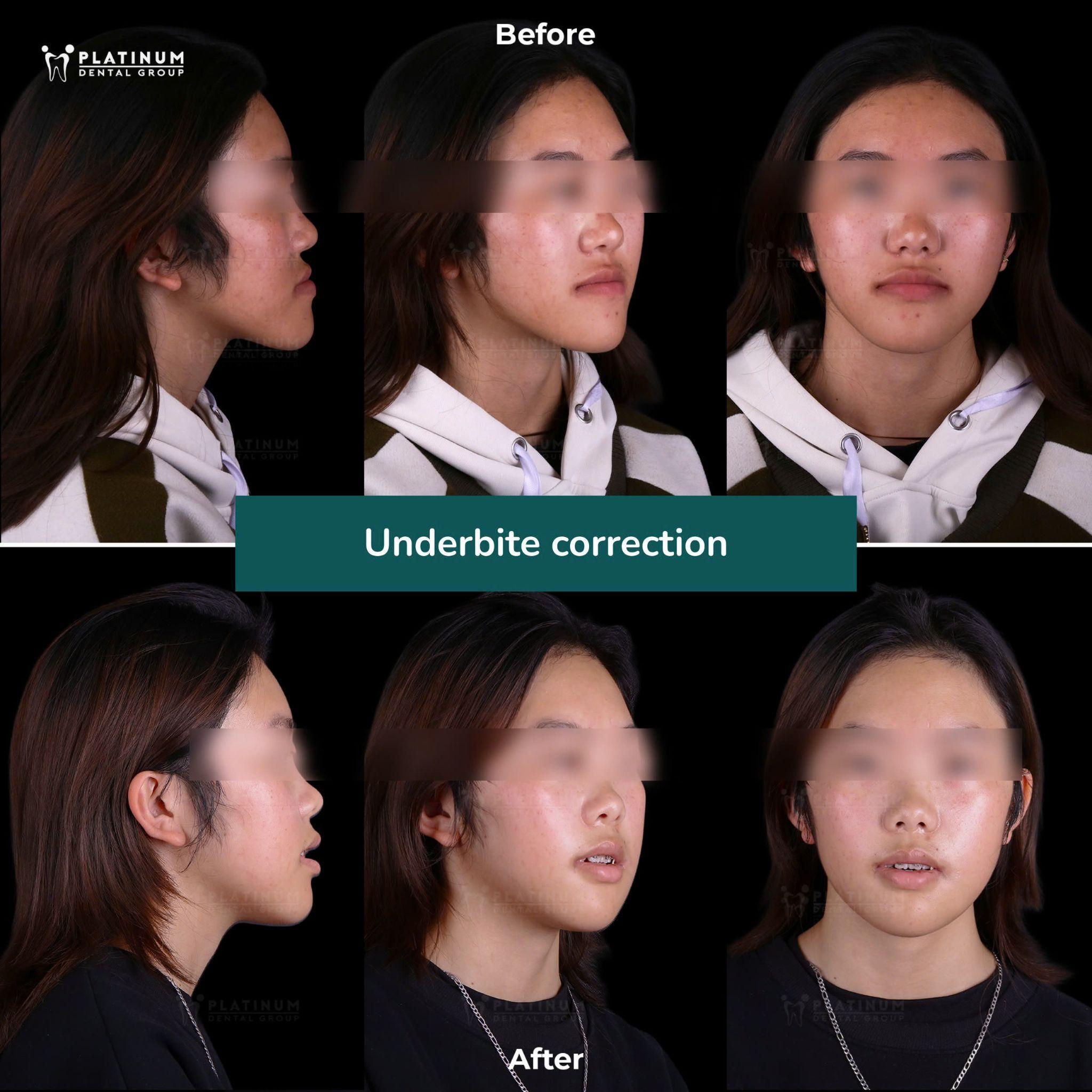 Orthognathic Surgery Before and After: Photos & Case Studies